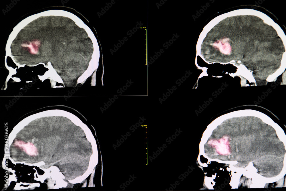 Brain CT scan, intracerebral hemorrhage Stock Photo | Adobe Stock