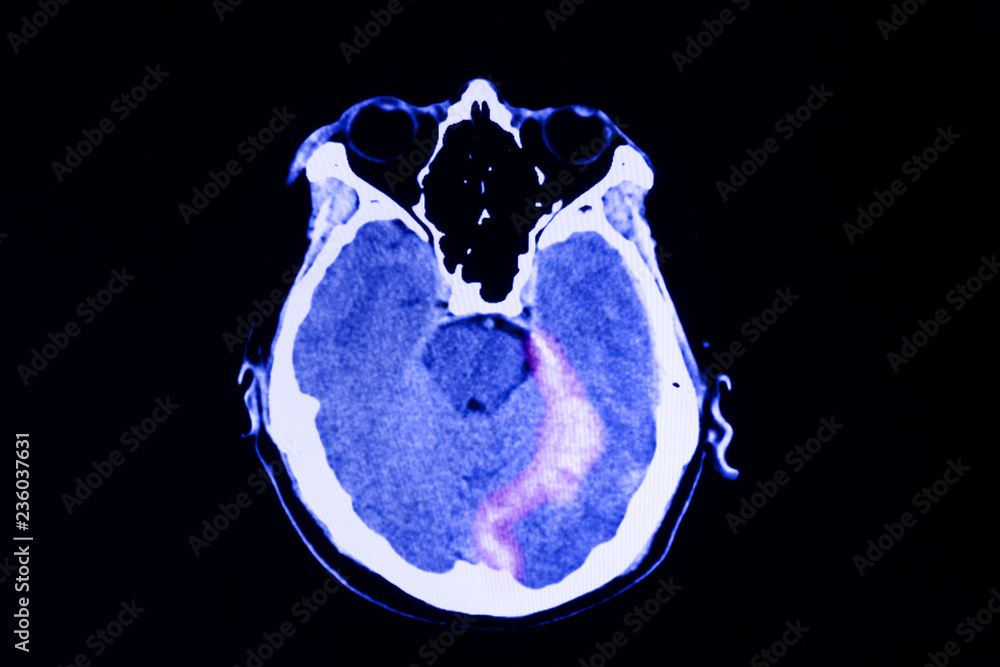 CT scan of a patient with traumatic brain injury Stock Photo | Adobe Stock