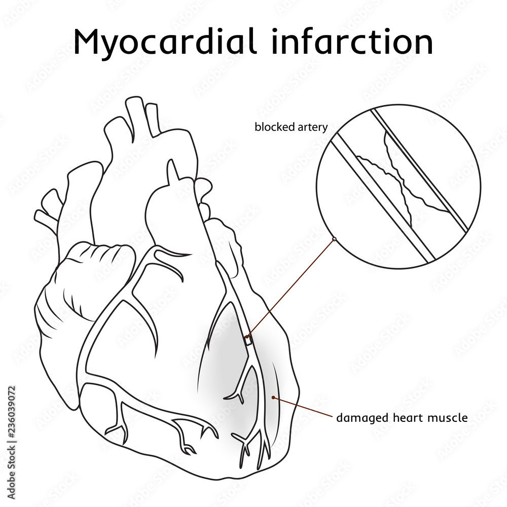 Myocardial Infarction Elevation St Inferior Stemi Wikidoc Ekg Examples ...