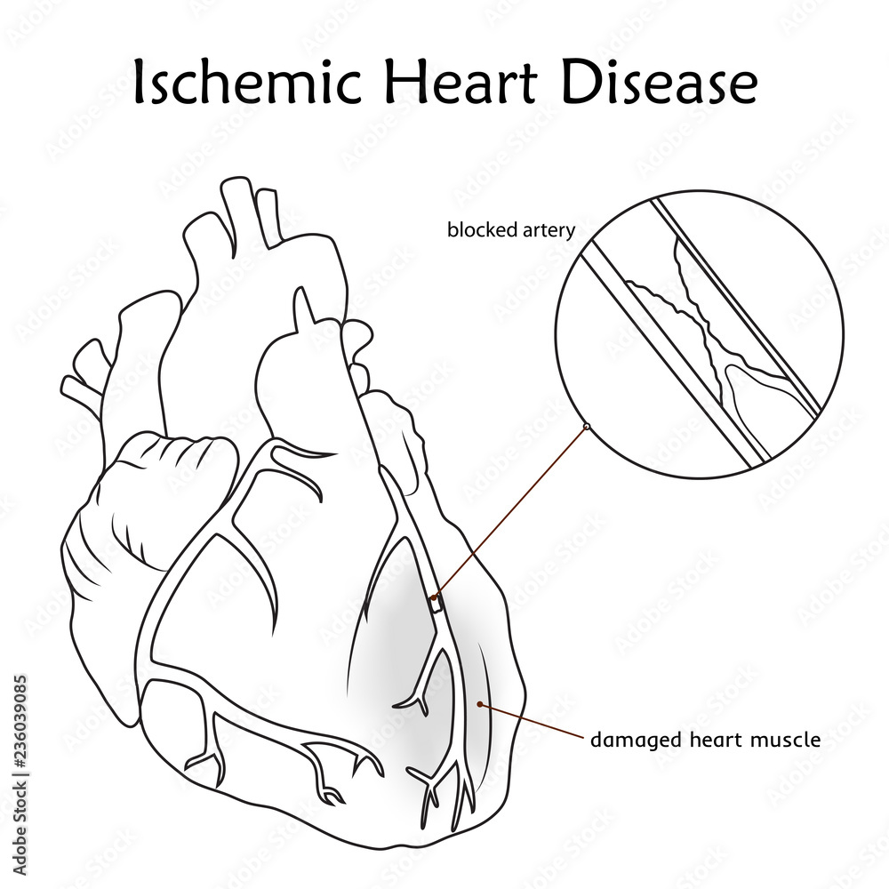 Ischemic Heart Disease. Blocked artery, damaged heart muscle. Anatomy ...