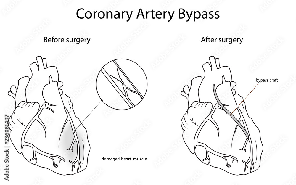 Coronary artery bypass, medical flat outline vector illustration ...