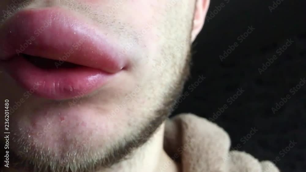 allergic reaction in a man on the lip. Angioedema. Quincke swelling ...