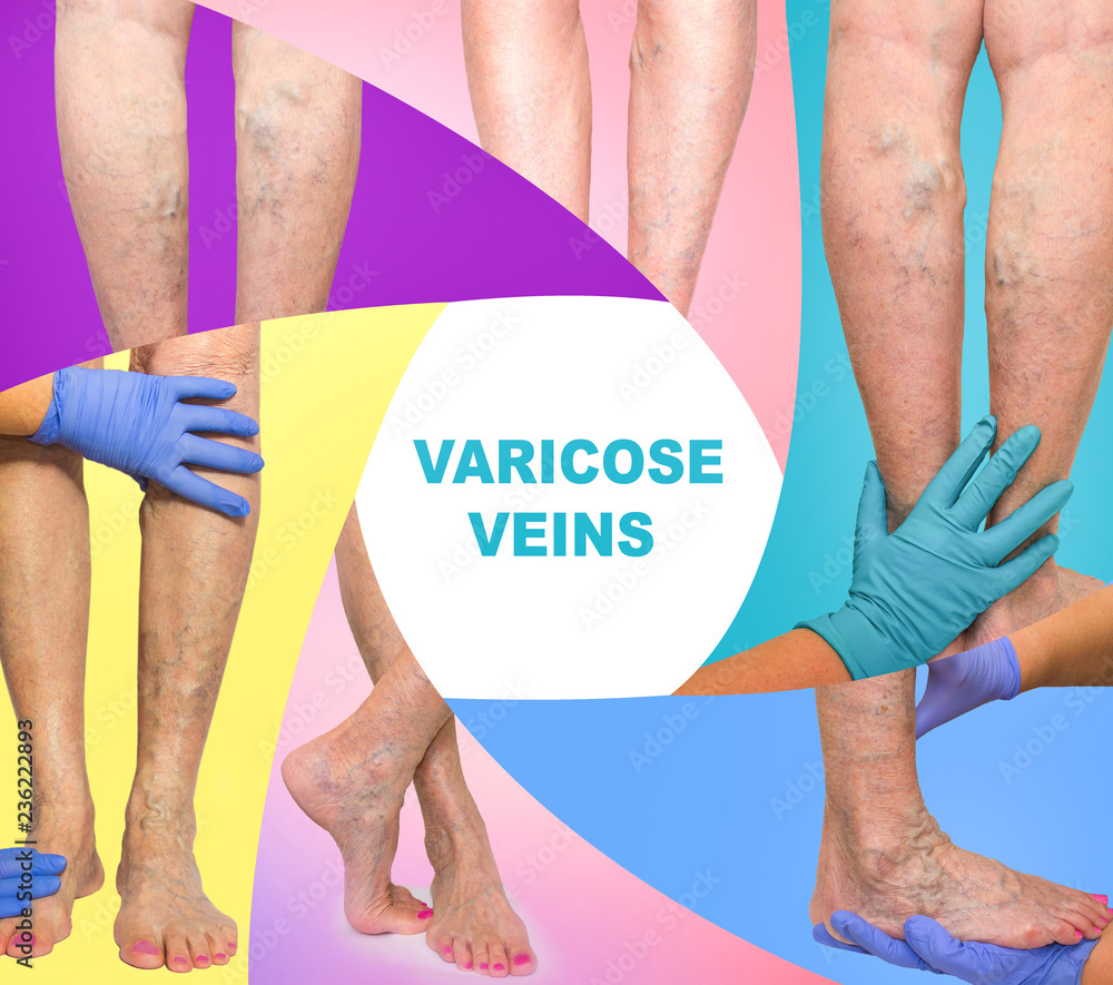 Varicose Veins On Lower Legs – How To Remove Varicose Veins – DYKOT