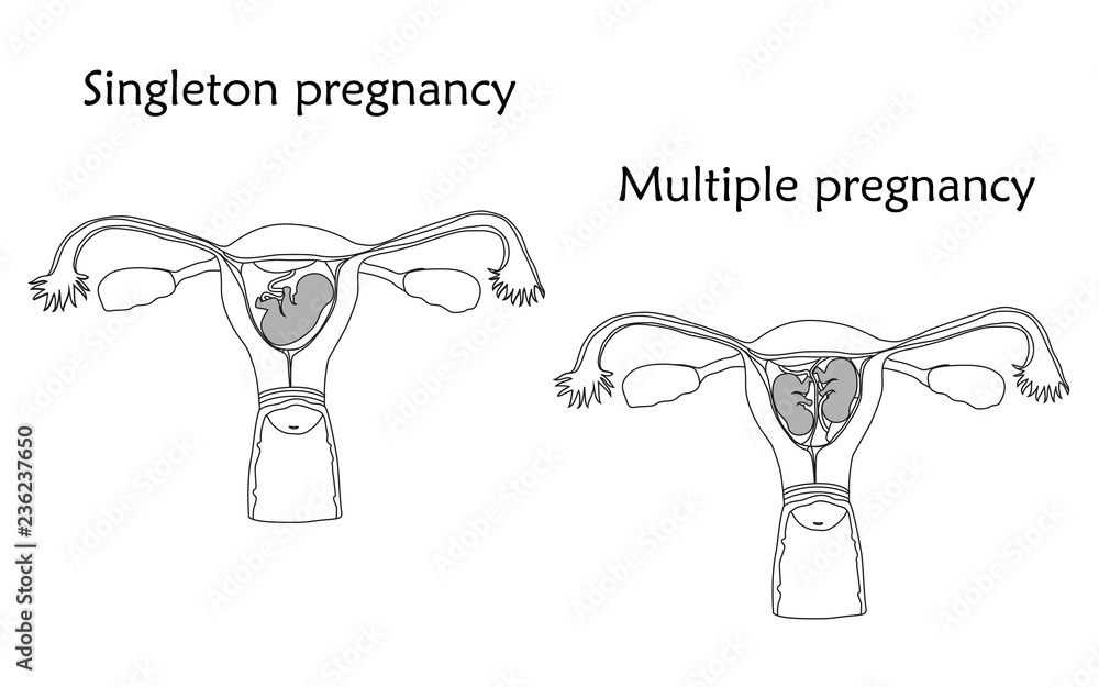 Triplet Pregnancy Diagram