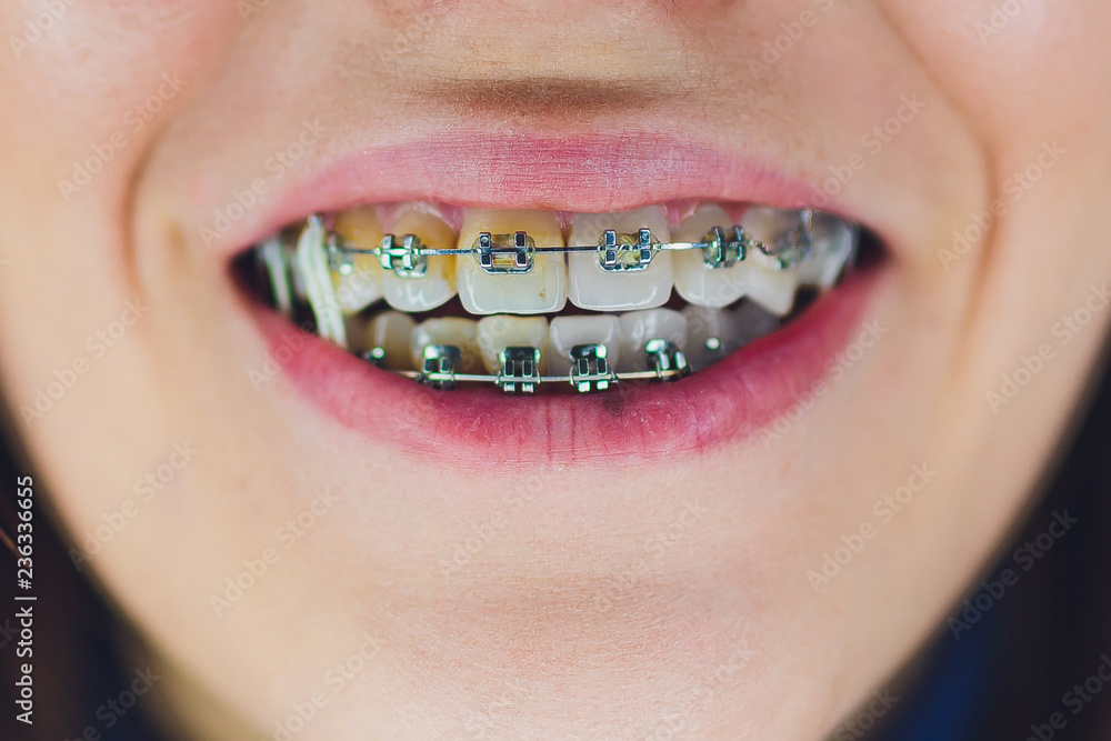 Disgusting Teeth With Braces