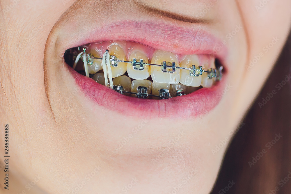 Yellow Teeth After Braces