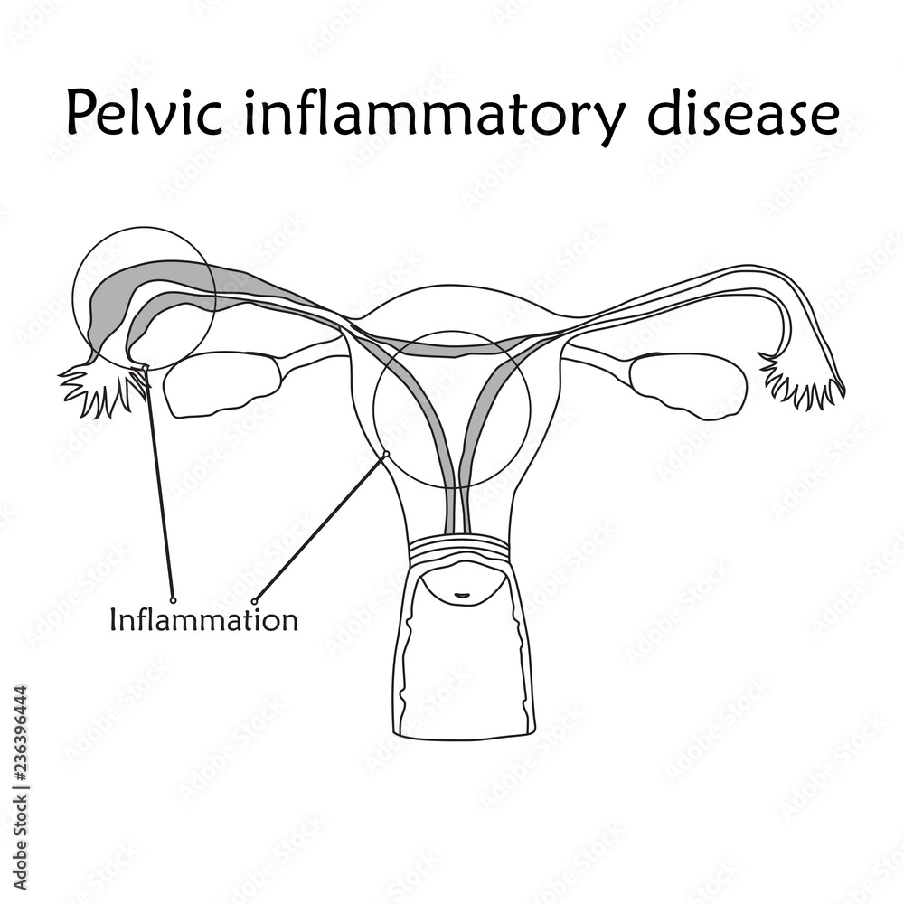 Pelvic inflammatory disease. Human realistic uterus. Anatomy flat ...