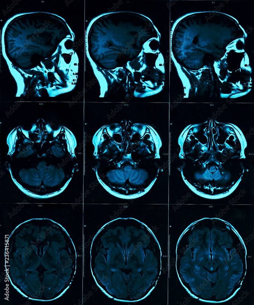 Magnetic resonance scan of the brain with skull. MRI head scan on dark ...