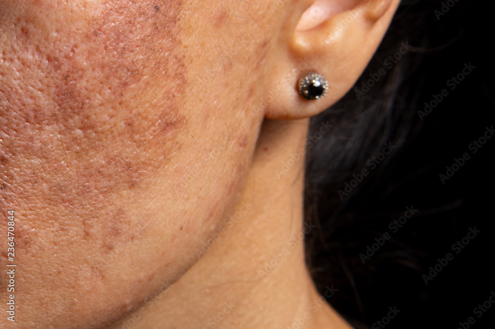 Increased Pigmentation Of Skin