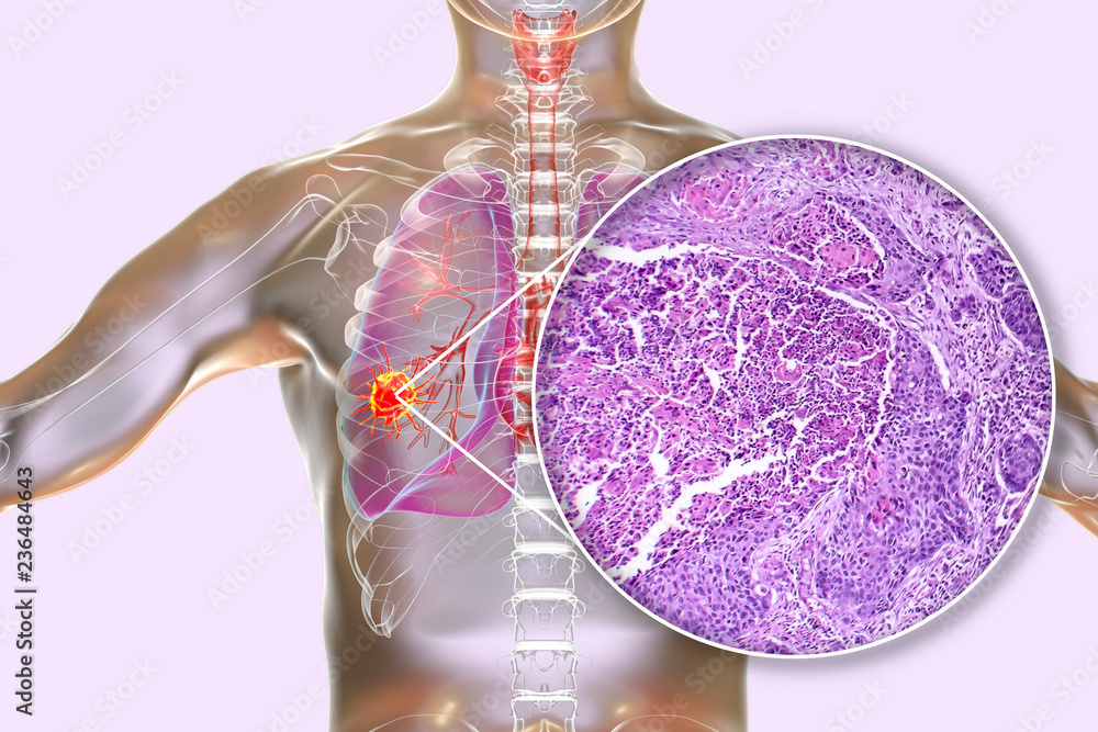 Lung Cancer Cells Under Microscope