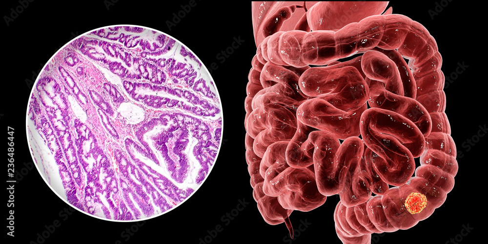 Colon cancer, 3D illustration and photo under microscope. Light ...