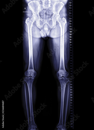 scanogram of lower limb or X-ray image of total lower extremity ...