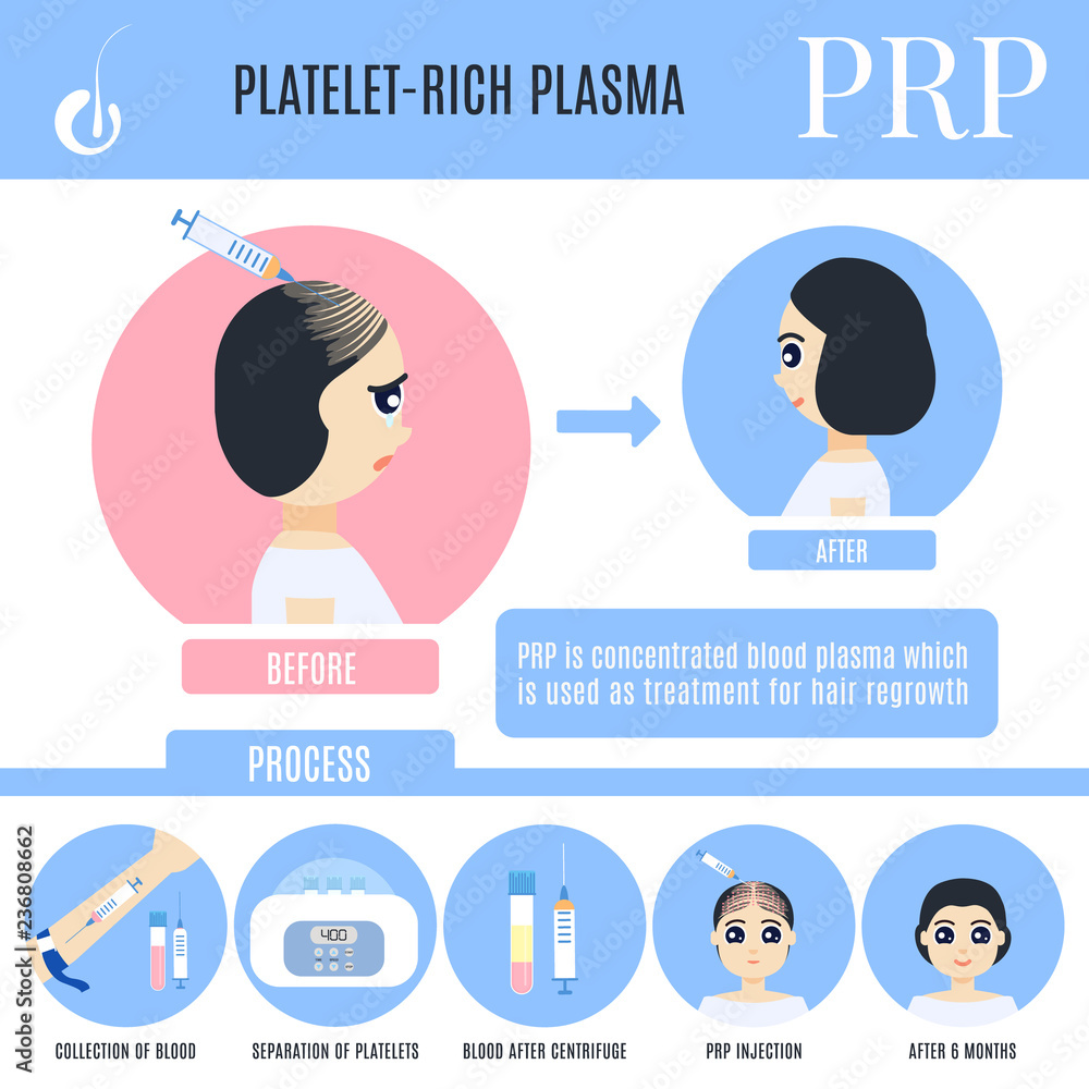 PRP female alopecia treatment medical poster in cartoon style Stock ...