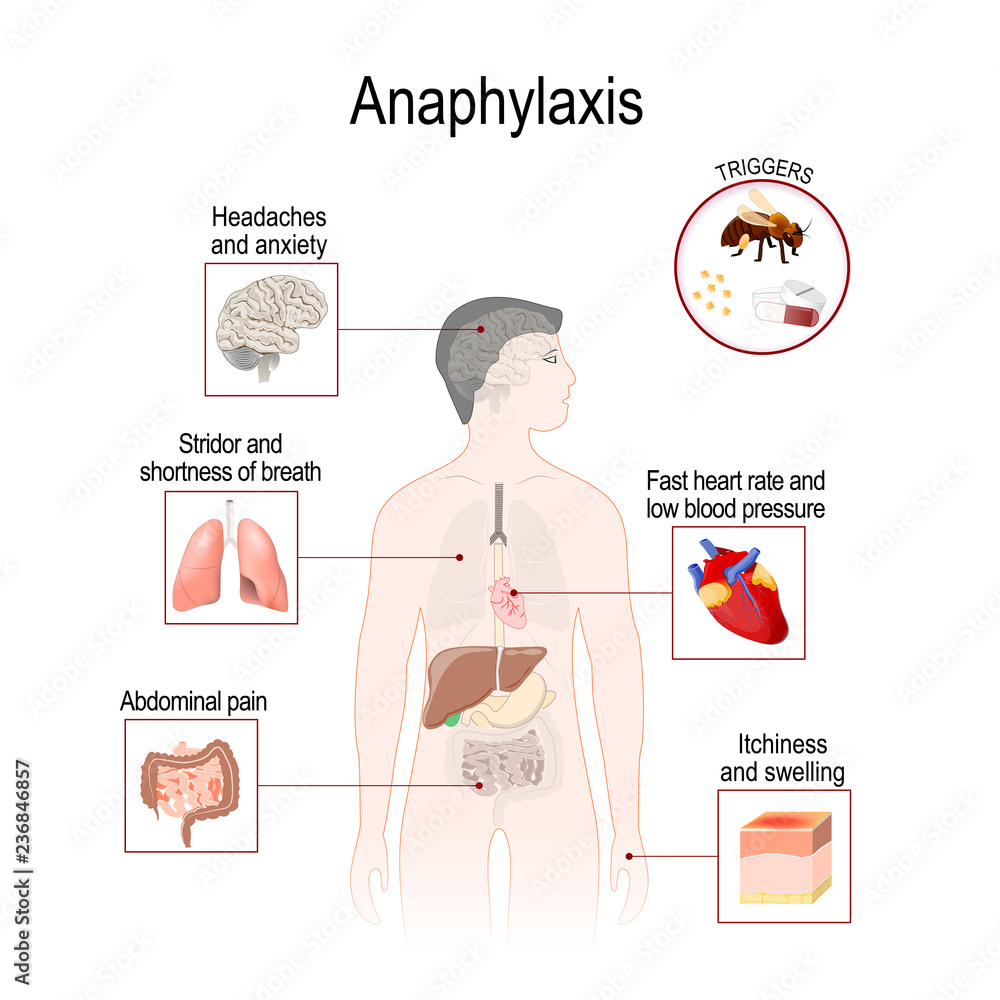 Anaphylaxis is a serious allergic reaction that may cause death Stock ...