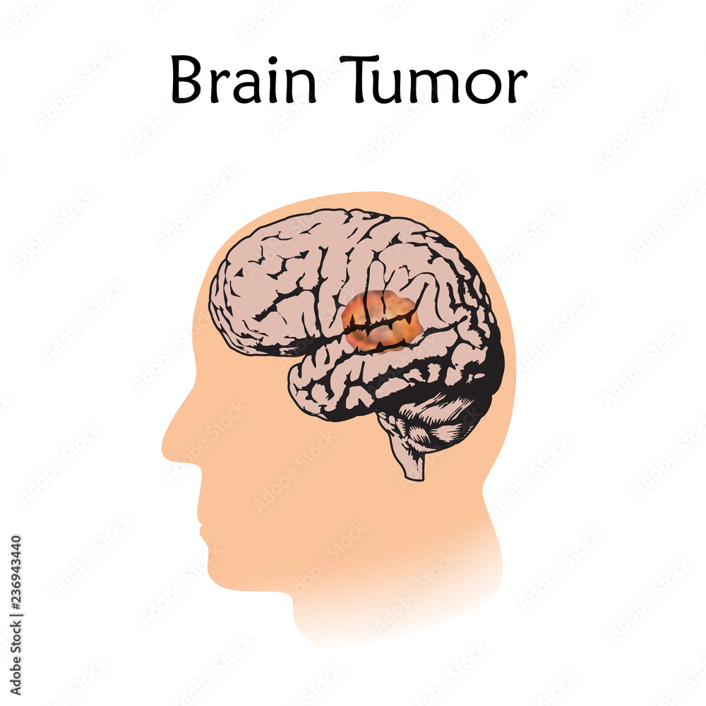 Brain tumors, cancer. Vector medical illustration. White background ...