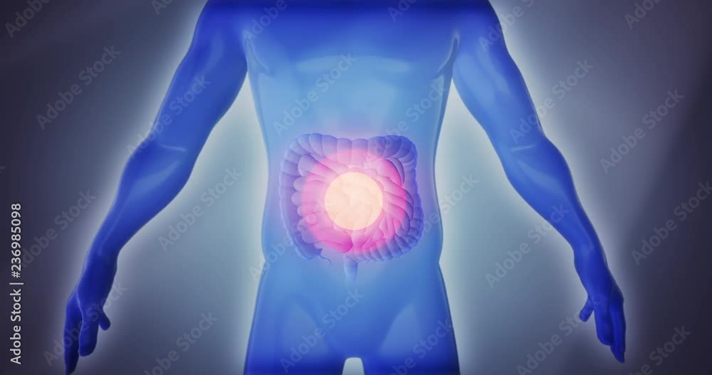 3D anatomy man suffering from intestine inflammatory bowel Disease ...