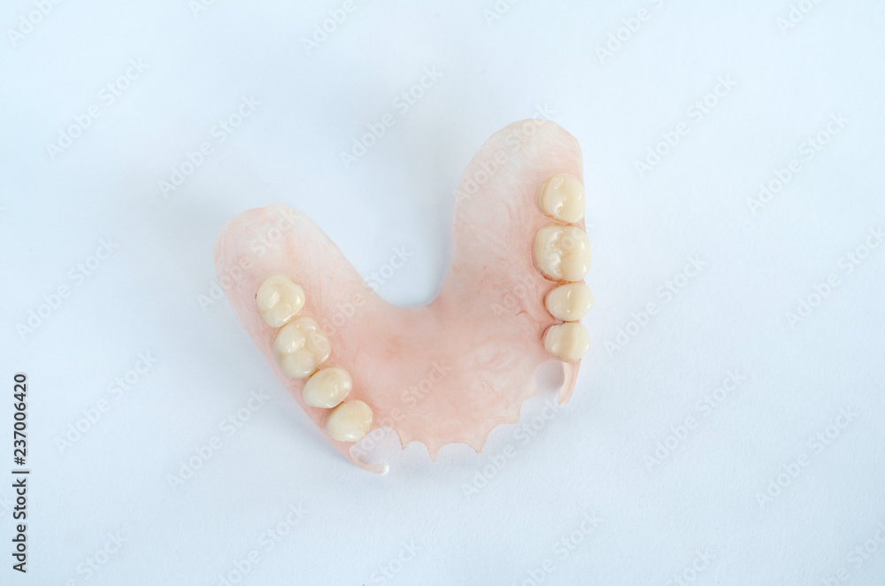 The upper part of the partial denture. Dental prosthetics. Stock Photo ...