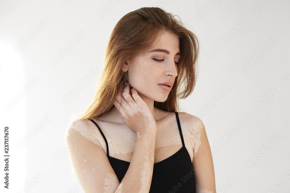 Image of beautiful young woman having white vitiligo spots on her body ...