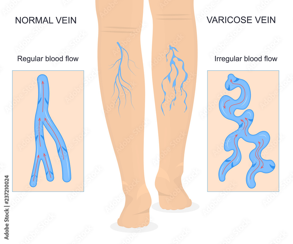 Varicose Veins Concept Banner Card with Elements. Vector Stock Vector ...