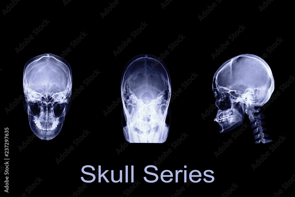 x-ray image of Human skull name is Skull Series (AP,LAT,Towne's view ...