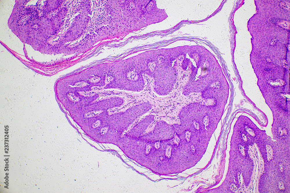 Skin papilloma Stock Photo | Adobe Stock