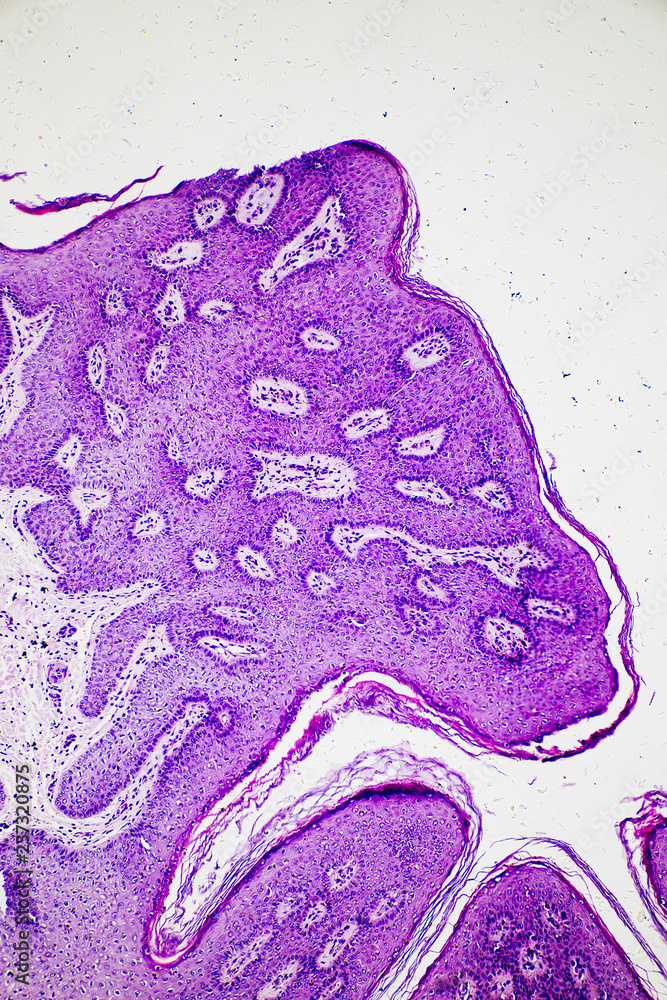 Skin papilloma Stock Photo | Adobe Stock