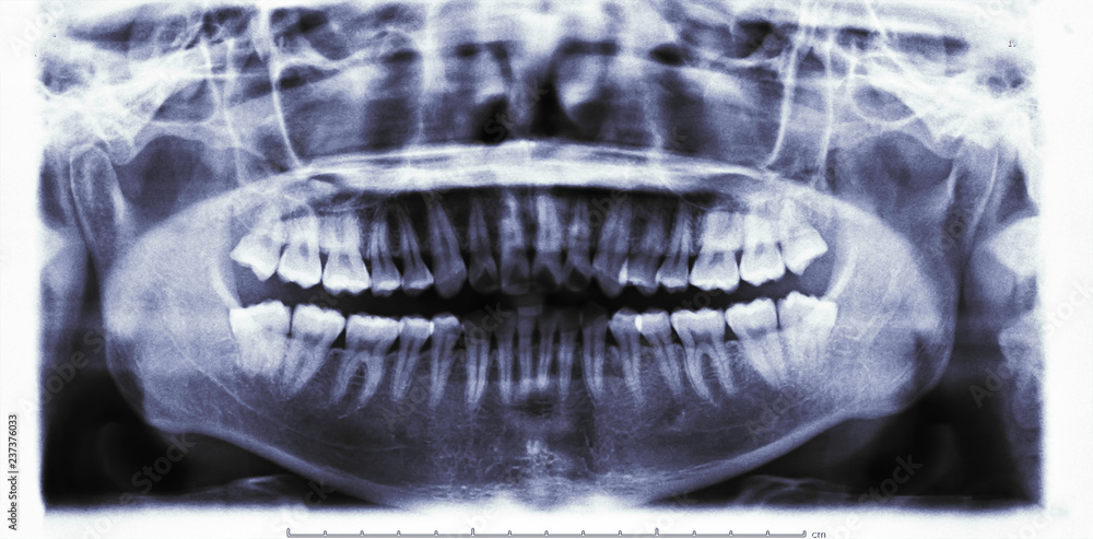Panoramic dental x-ray image or orthopantomogram of jaw with all teeth ...