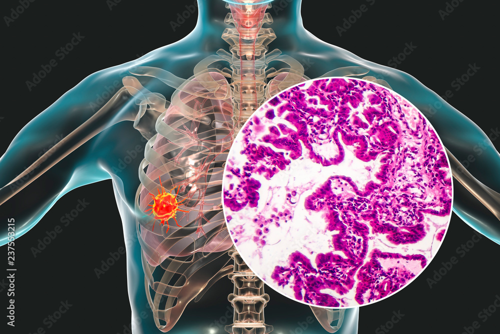 Lung cancer, 3D illustration and photo under microscope. Light ...