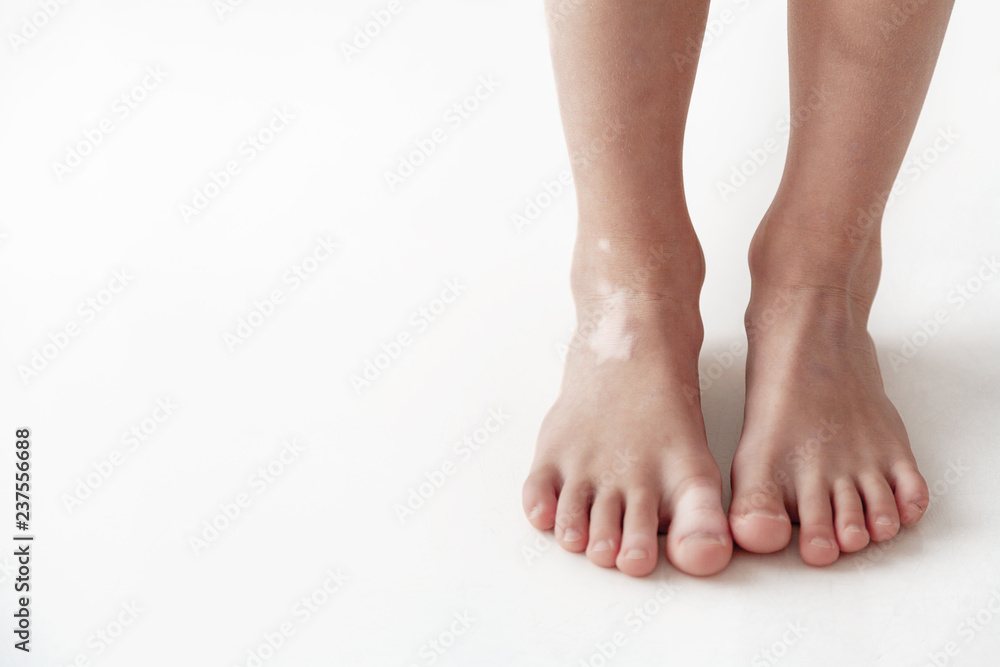 Feet on a white background. Pigmentation on the skin. White spots ...