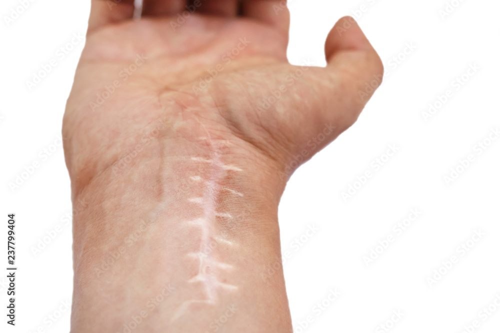 Scaphoid Fracture Surgery Scar