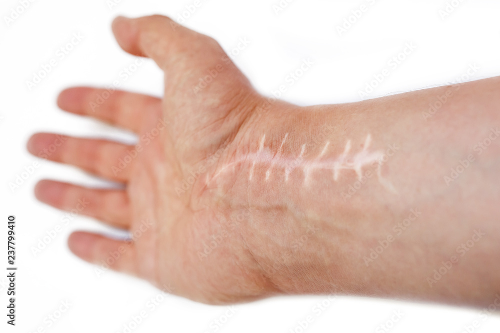 Scar with stitches on the wrist after surgery. Fracture of the bones of ...