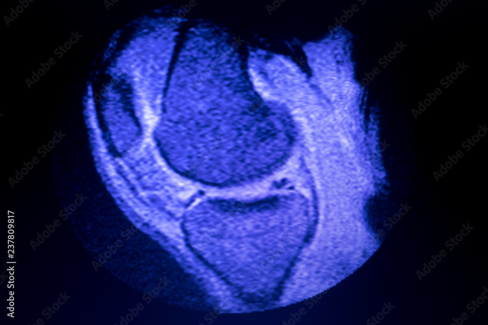 Mri Knee Meniscus