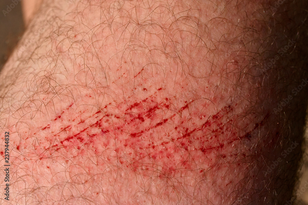 Scratch skin, wound or cut on the skin, red blood. Hairy part of a man ...
