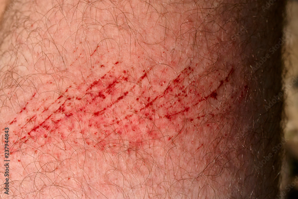 Scratch skin, wound or cut on the skin, red blood. Hairy part of a man ...