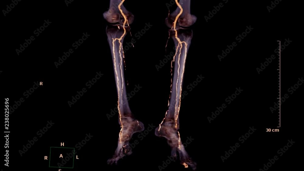 CTA femoral artery run off CT images demonstrated calcified plaques and ...