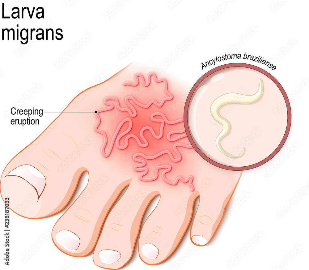 Cutaneous larva migrans. Skin disease in humans. Stock Vector | Adobe Stock