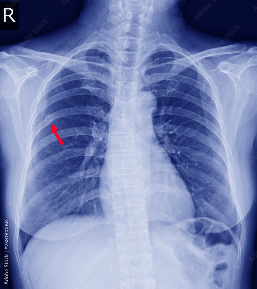 Chest x-ray Fracture right posterior 6th rib and possible fracture ...
