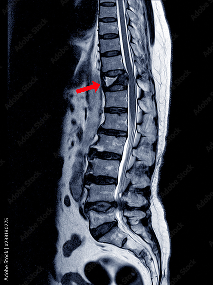 MRI Thoracic lumbar spine show moderate pathological compression ... MRI Thoracic lumbar spine show moderate pathological compression ...