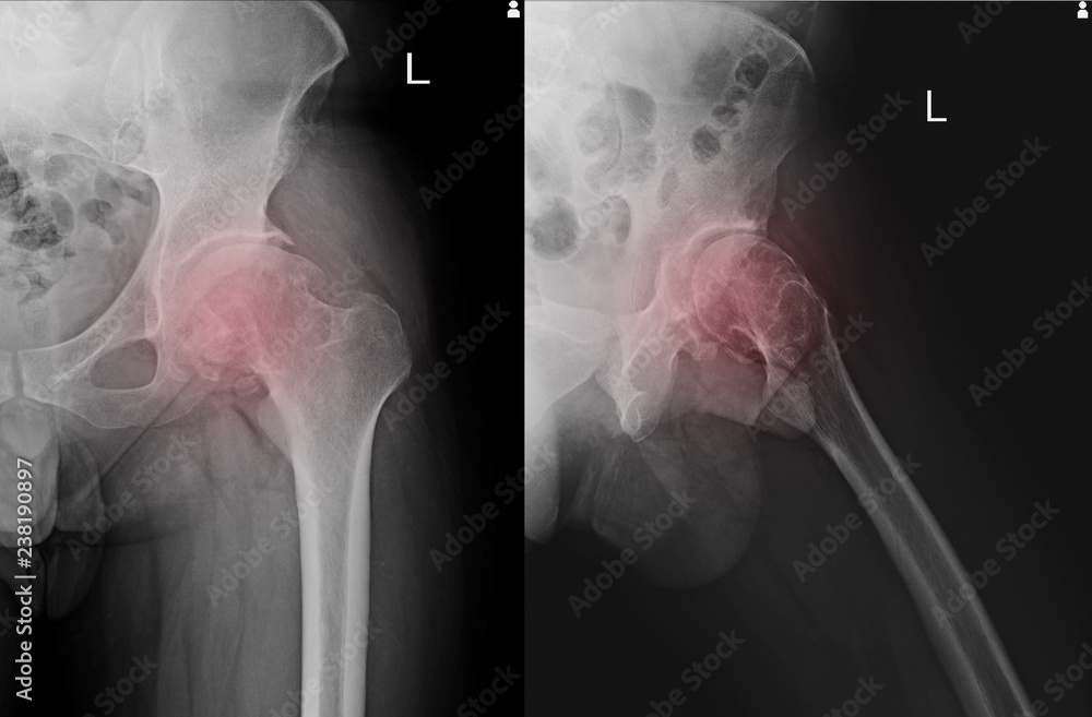 Sclerosis of articular surface of acetabular with marginal osteophytes ...