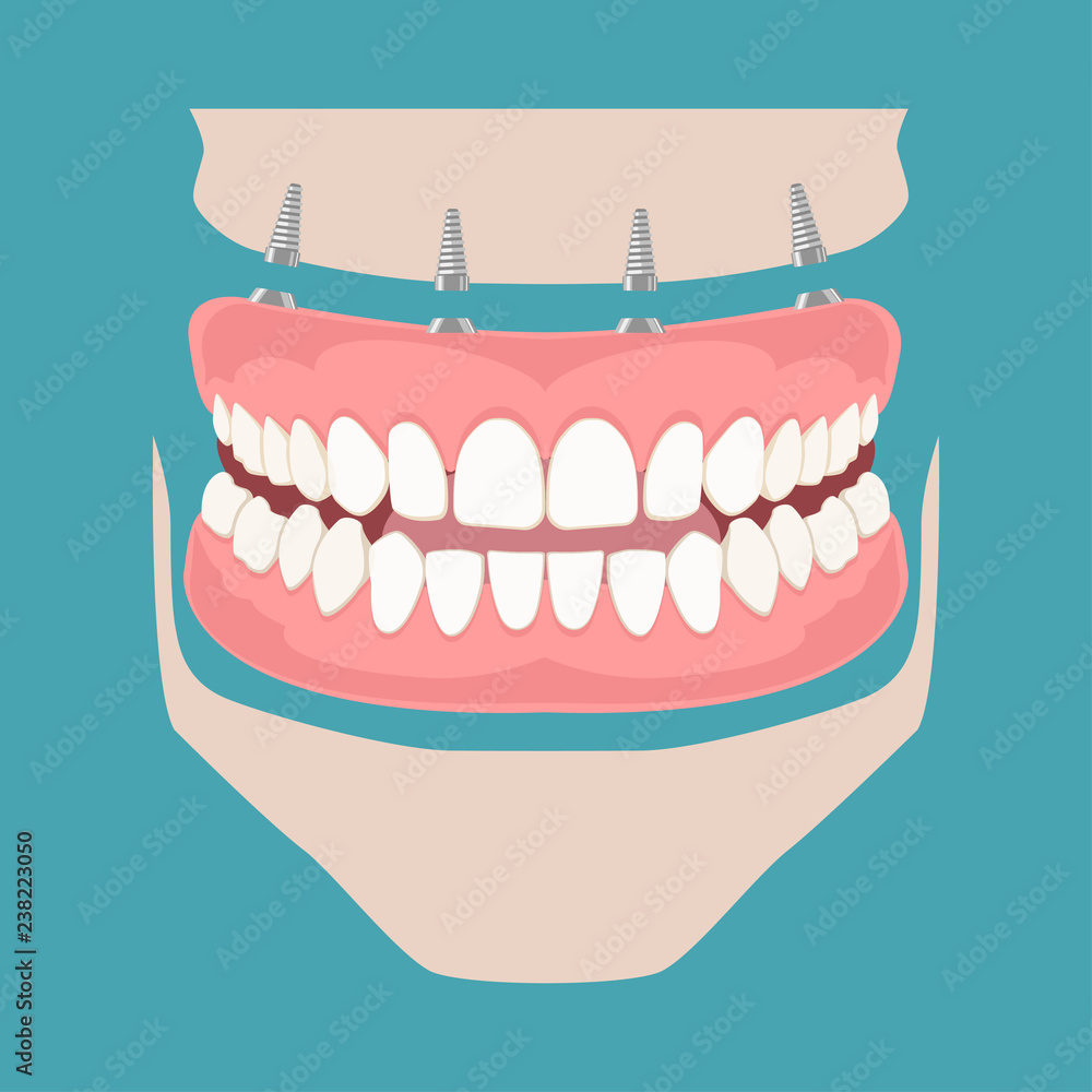 Removable denture on implants. Removable denture of the upper and lower ...