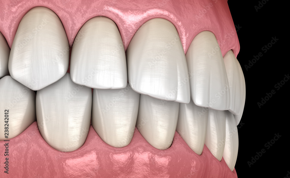 Healthy human teeth with normal occlusion, side view. Medically ...