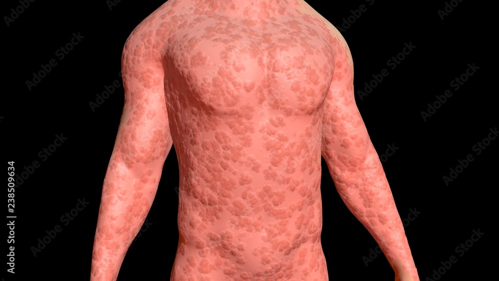 Skin Problems :red bumpy infected skin on torso . 3d render Stock ...