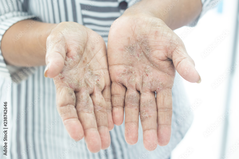 Atopic Dermatitis Palms