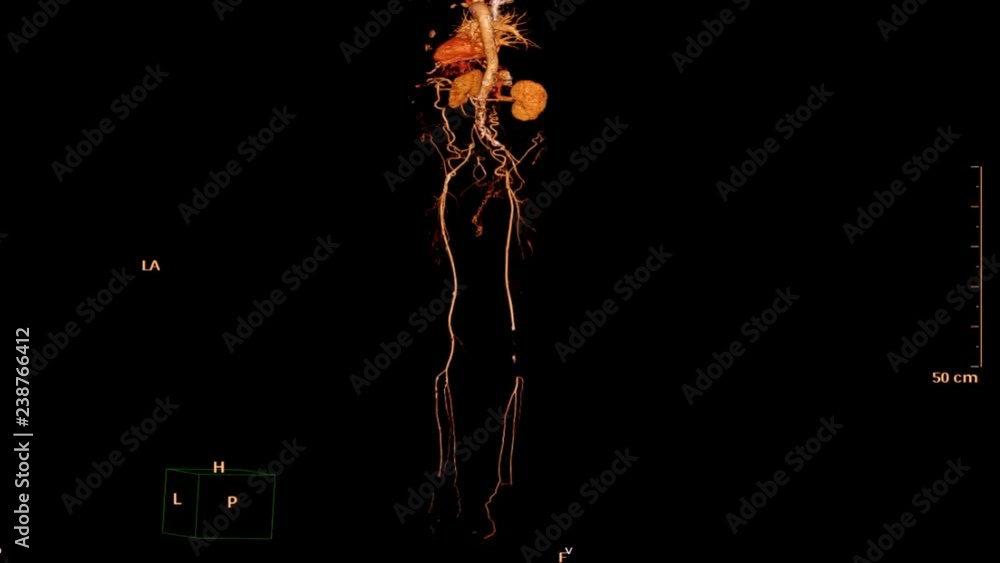 CT Scan 3D rendering image of CTA femoral artery run off showing ...