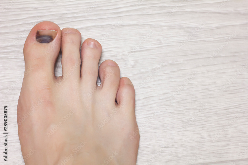 Injury to the nail on the foot, close-up, hematoma under the nail, copy ...
