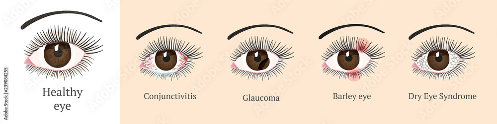 Most common eye problems. Stock Vector | Adobe Stock