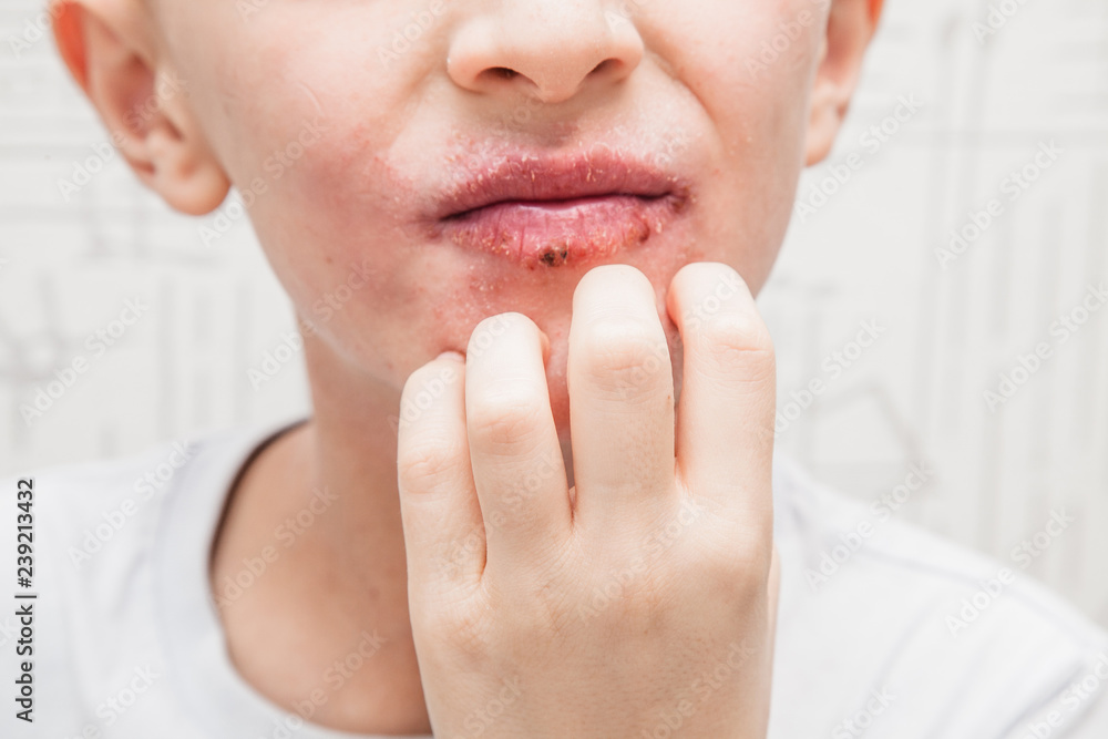Boy scratching his face. Human skin, presenting an allergic reaction ...
