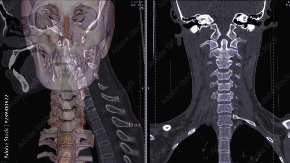 CT SCAN of Cervical Spine ( C-spine ) 3D rendering image comparison ...