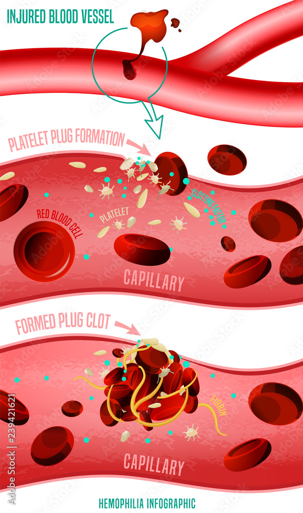 Blood clot formation Stock Vector | Adobe Stock