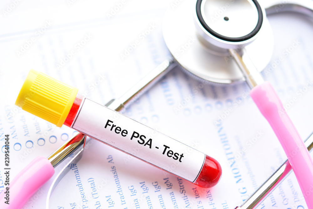 Blood sample for free PSA test, diagnosis for prostate cancer Stock ...